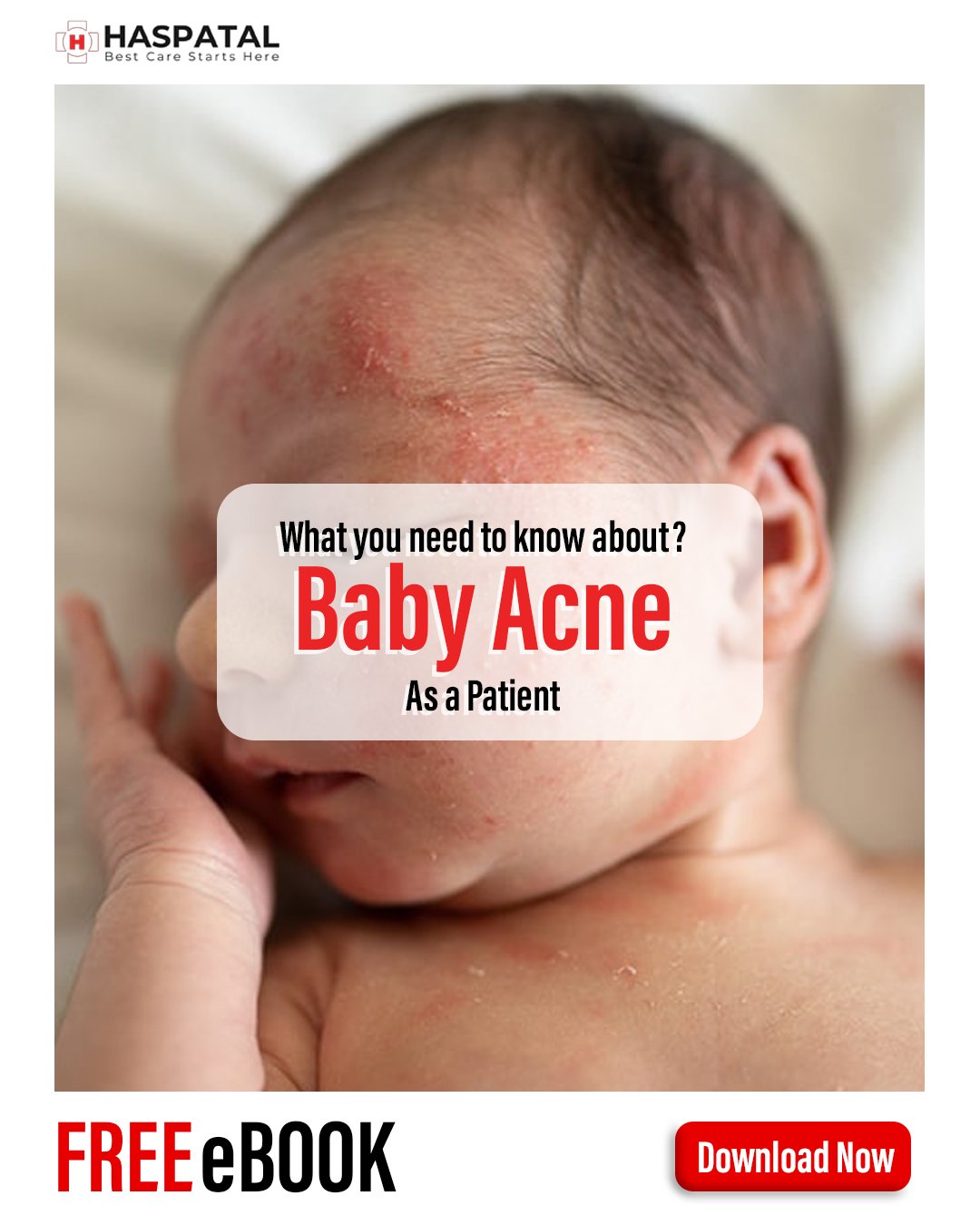 Baby Acne and its symptoms - Haspatal online consultation app ...